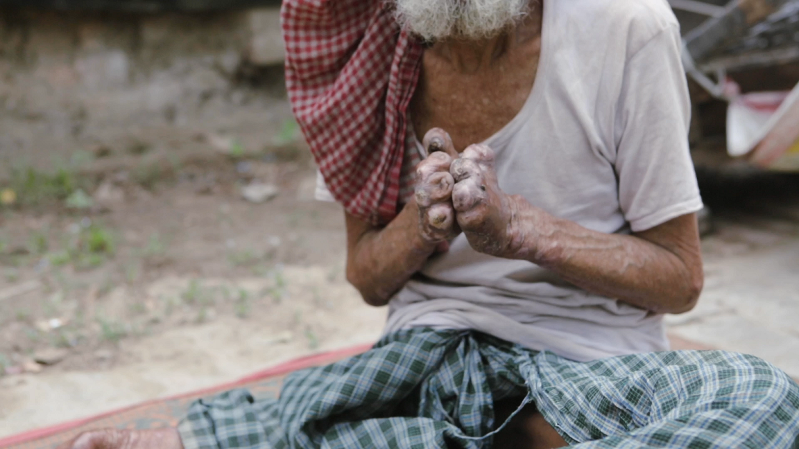 India Has More Than Half Of The World’s New Leprosy Cases, Here’s How We’re Fighting It ...